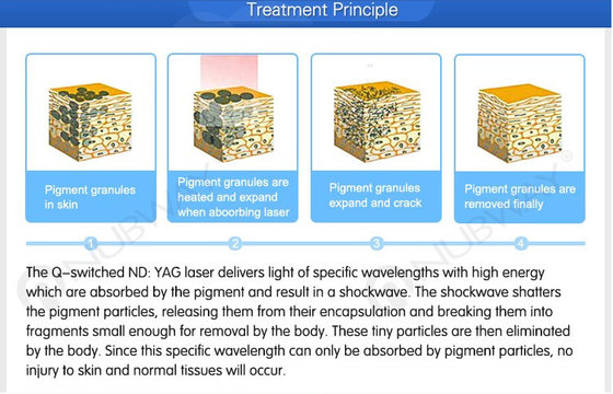 free door to door training tattoo remove yag laser machine for skin rejuvenation