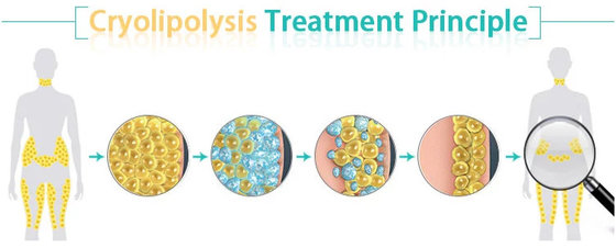 cryo 4 cocoon beauty tighten cryolipolysis system cryo fat freezing cryolipolysis machine