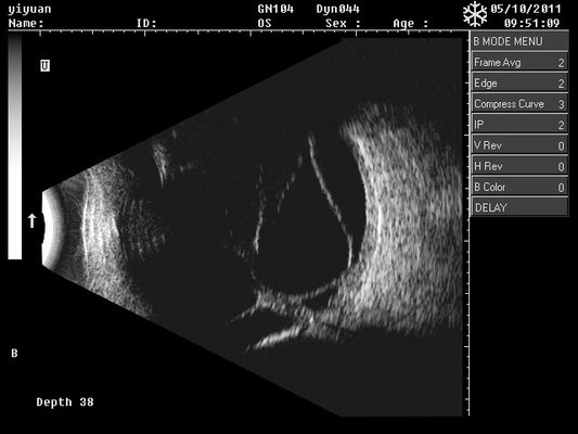 Best selling OD5 A/B Scan Human Ophthalmic Portable Ultrasound Biometry Eye Health Ophthalmology Health