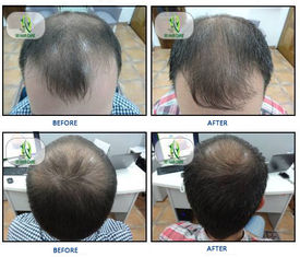 LLLT Low Level Laser Multifunction Beauty Machine Anti - Hair Loss