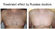 1-12 Hz Portable 808nm Diode Laser Hair Removal Machine Ce Approved